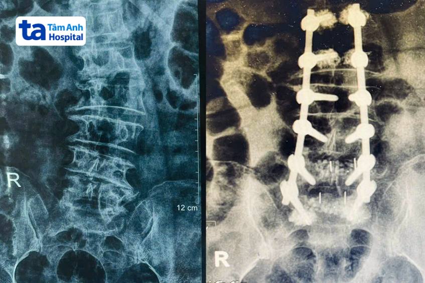 Cam go mổ sáu đốt sống cho cụ bà béo phì, loãng xương nặng