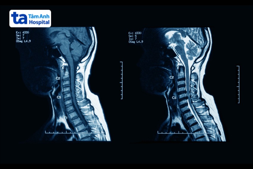 Chụp MRI cổ: Quy trình thực hiện, ưu điểm và điều cần lưu ý