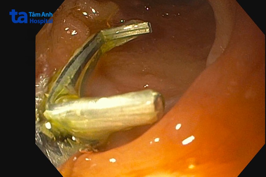 Cứu kịp thời bé 9 tháng tuổi nuốt nhiều ghim bấm