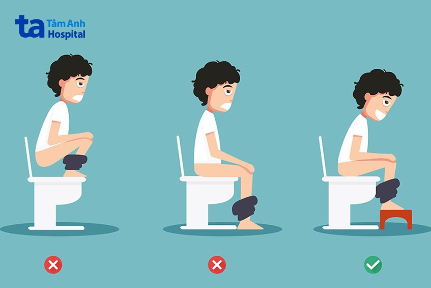 Trĩ độ 1 có cần phẫu thuật? Khi nào cần can thiệp y tế?