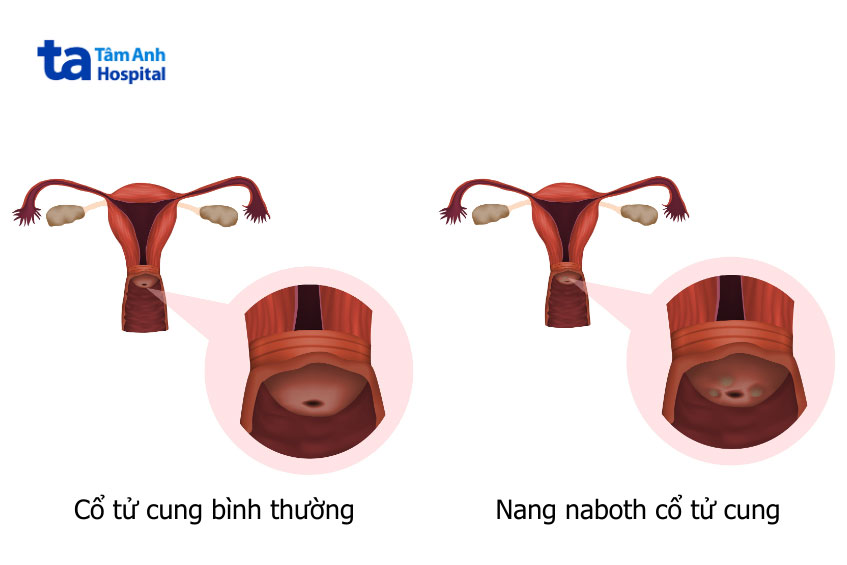 3 dấu hiệu vỡ nang naboth cổ tử cung và các biến chứng có thể gặp