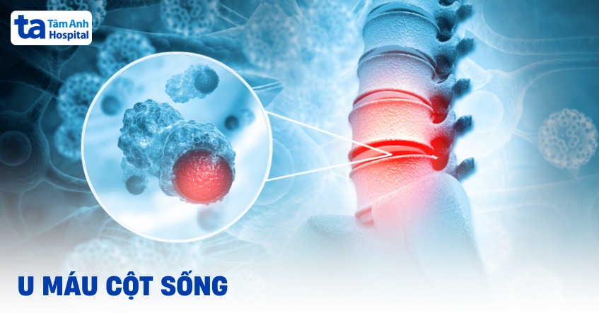 Ho đau đầu: Triệu chứng, nguyên nhân, chẩn đoán và điều trị