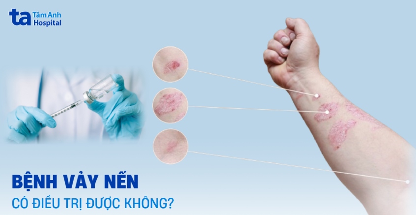 13 cách trị vảy nến an toàn phổ biến giúp chữa khỏi bệnh