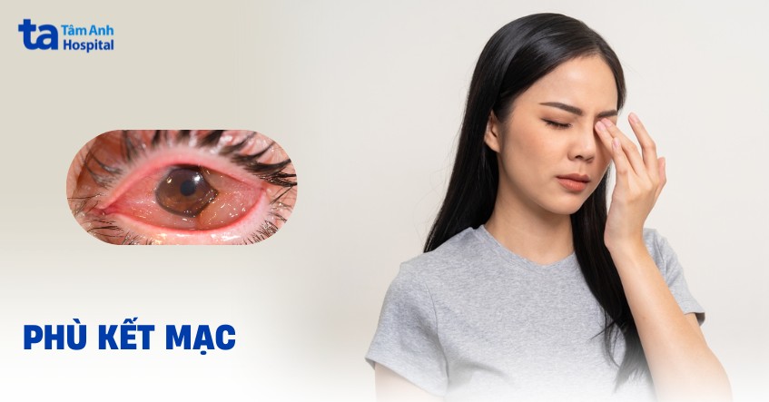 Phù kết mạc: Nguyên nhân, triệu chứng, chẩn đoán và điều trị
