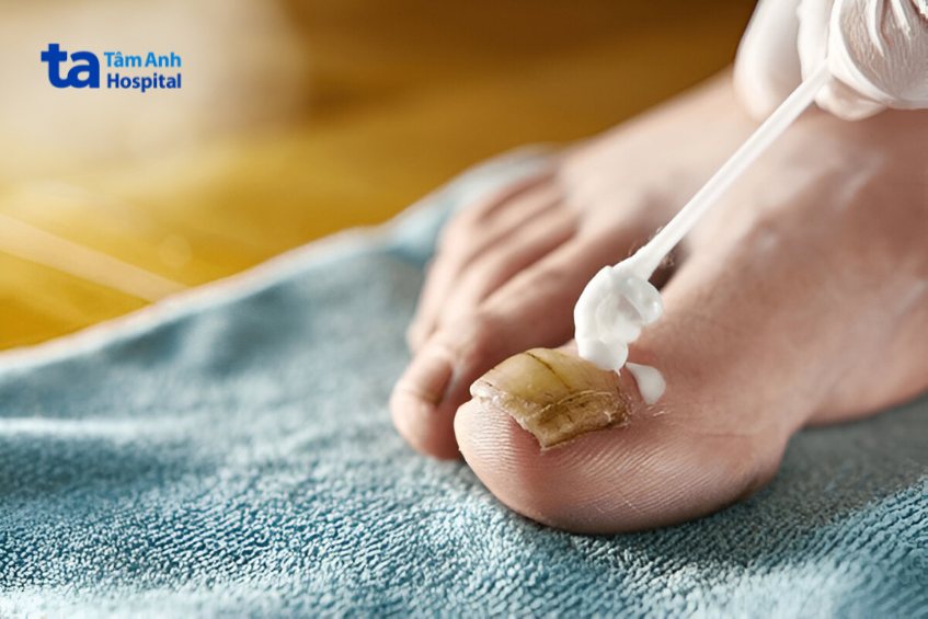 Nấm kẽ móng chân: Nguyên nhân, dấu hiệu, chữa trị, phòng ngừa