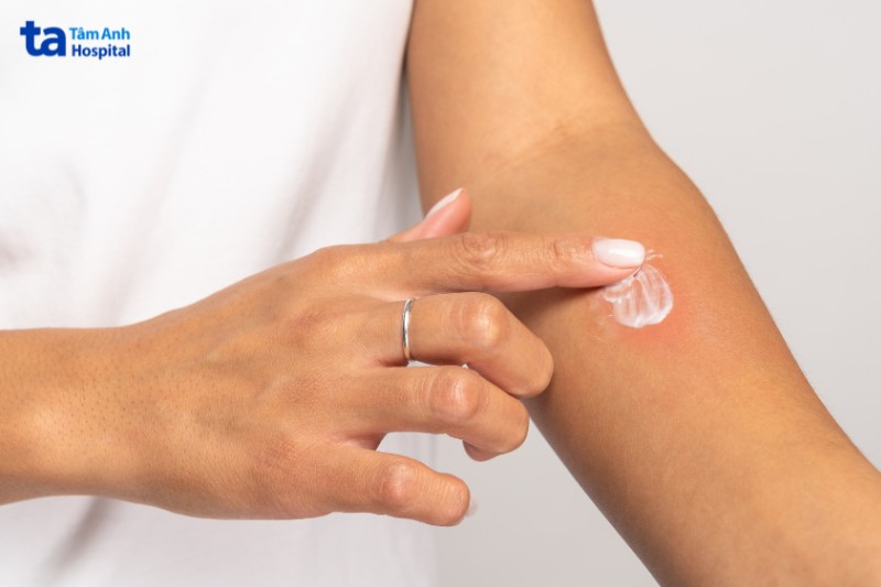 Rám má là gì? Nguyên nhân, cách điều trị và phòng bệnh