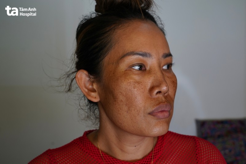 Rám má là gì? Nguyên nhân, cách điều trị và phòng bệnh