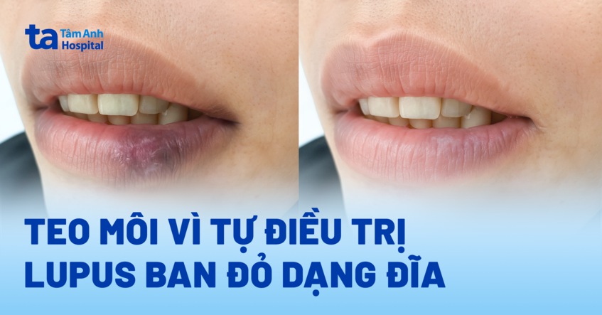 Teo môi vì lupus ban đỏ dạng đĩa | BVĐK Tâm Anh