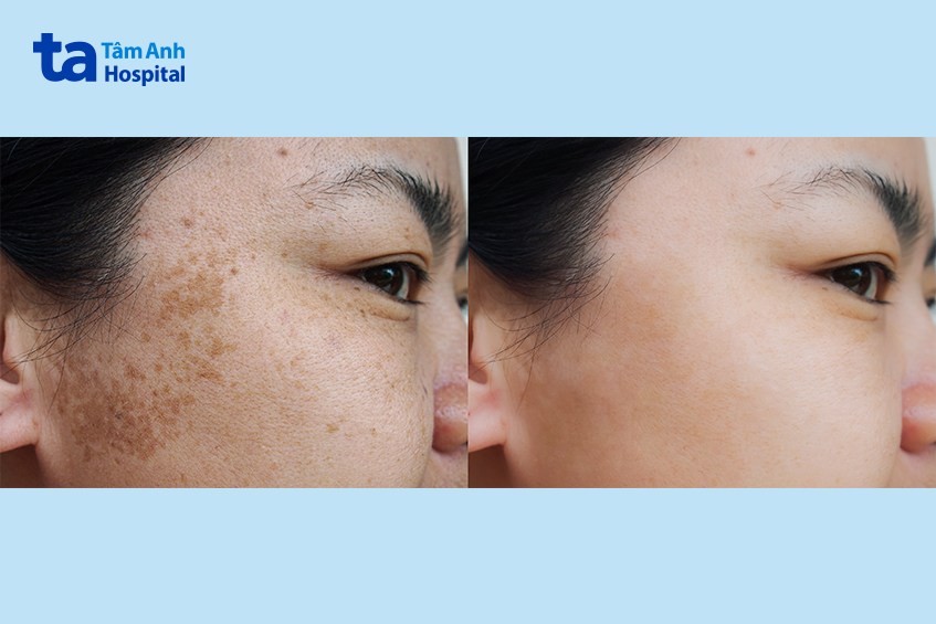 Tiêm meso bao lâu thì tan hết? Bao lâu hết sưng?