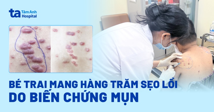 Bé trai mang hàng trăm sẹo lồi do biến chứng mụn