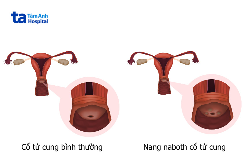 Cổ tử cung có nang naboth 5mm nguy hiểm không? Cách điều trị