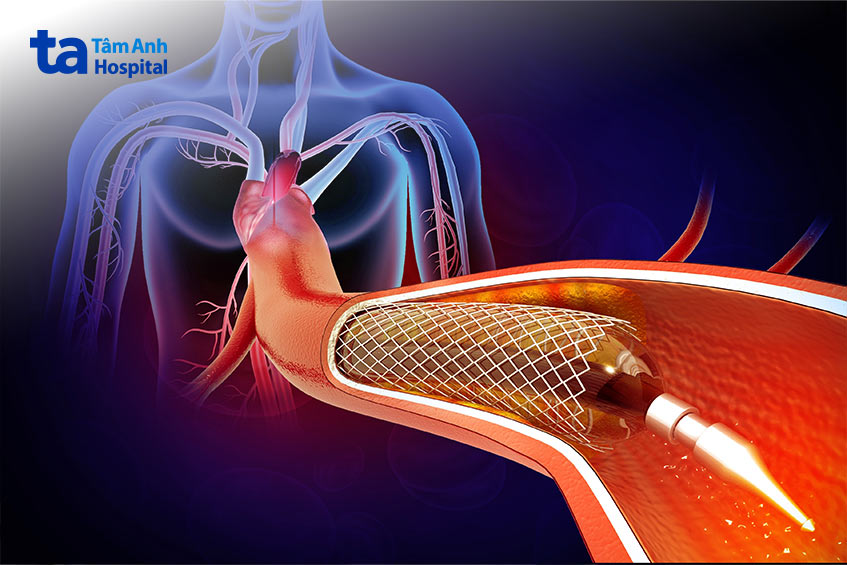 4 loại stent động mạch cảnh thường dùng phổ biến hiện nay